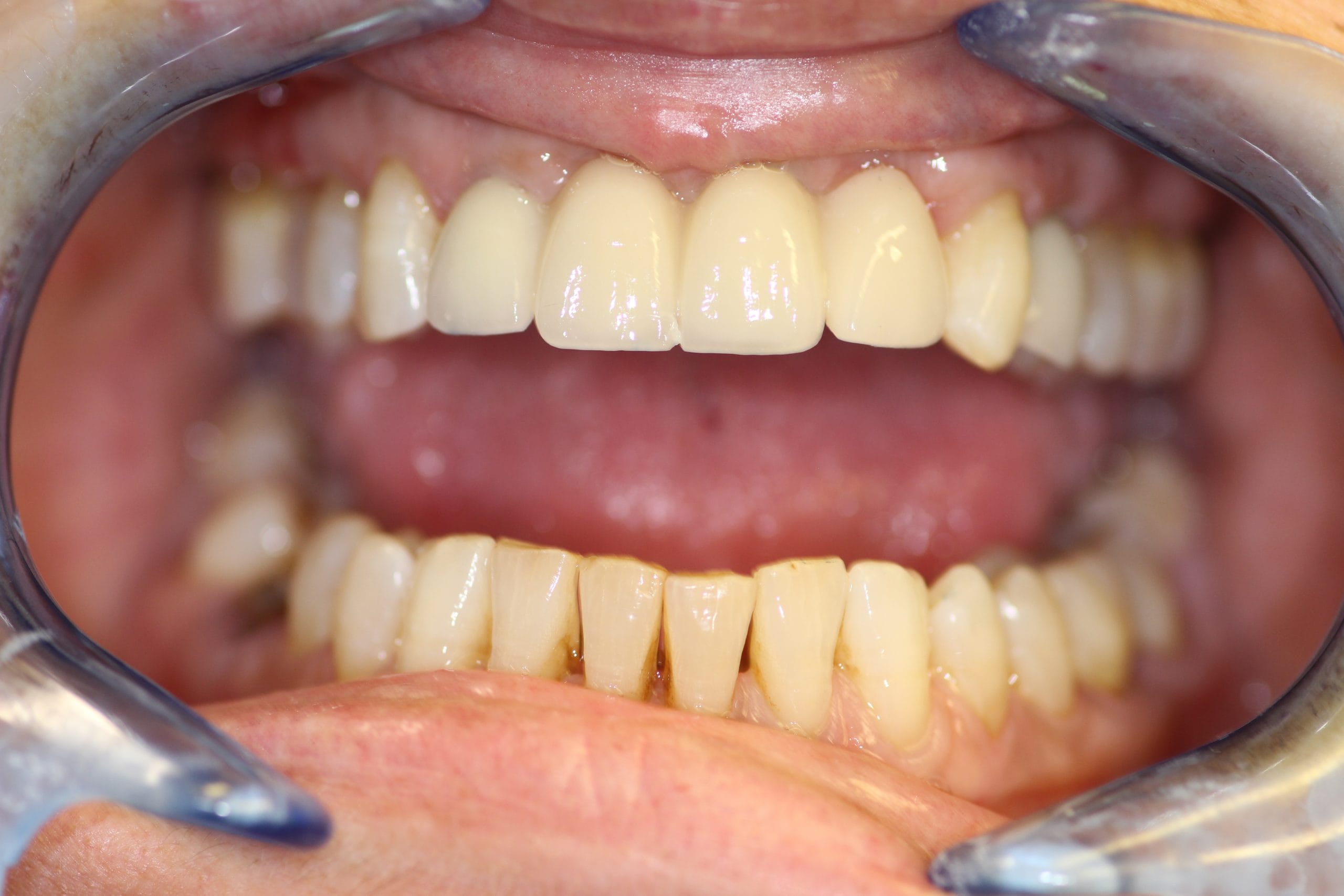 All on 4 Implants – The game-changing dental solution you need to know ...